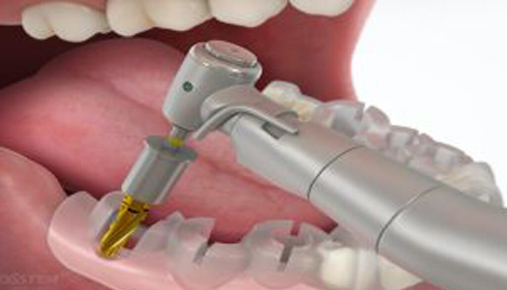 Osstem OneGuide Kit – Dentiss